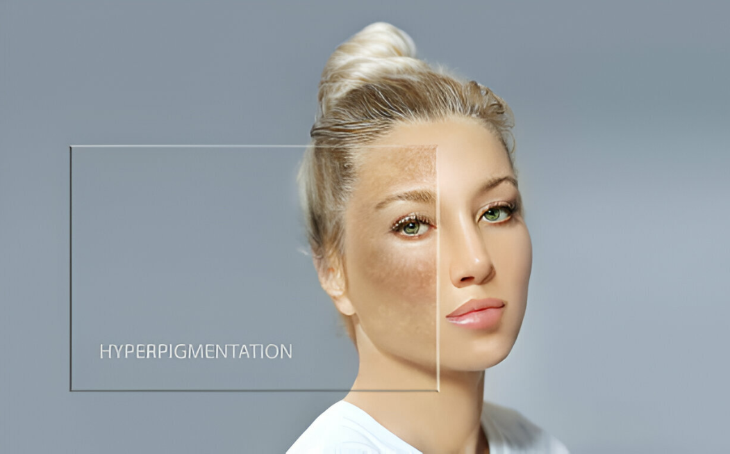 Skin Pigmentation: Causes, Types, and How to Reduce it